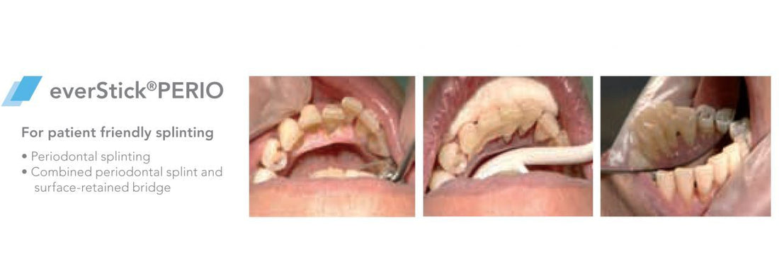 Gc Dental - EverStick PERIO - Fibre Reinforcement for Periodontal ...